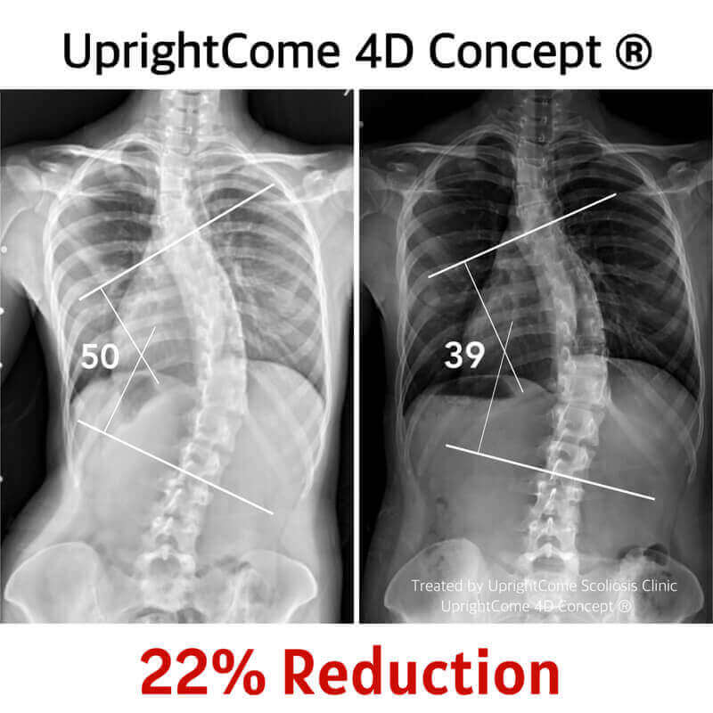 Scoliosis Curve Reduction – Cobb Angle from 50 degrees to 39 degrees